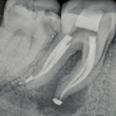 Digital X-Rays and 3D Imaging in Illinois | Renovo Endodontics Studio