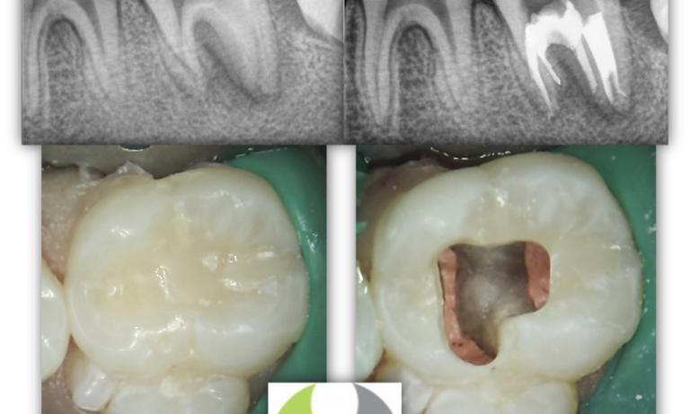 Gemination - Renovo Endodontic Studio