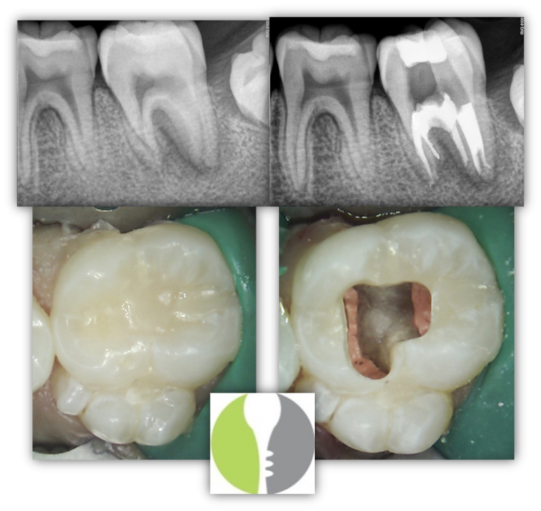 Gemination - Renovo Endodontic Studio