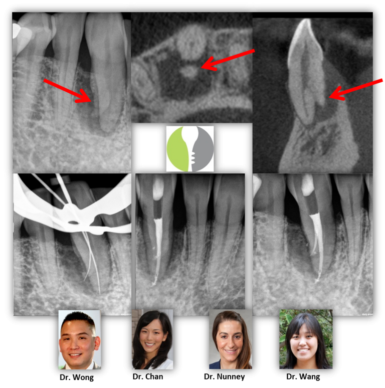 Dental Anatomy and Root Canals: Canine Tooth Tail | Renovo Endodontic ...
