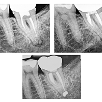 Intentional Replantation | Renovo Endodontic Studio