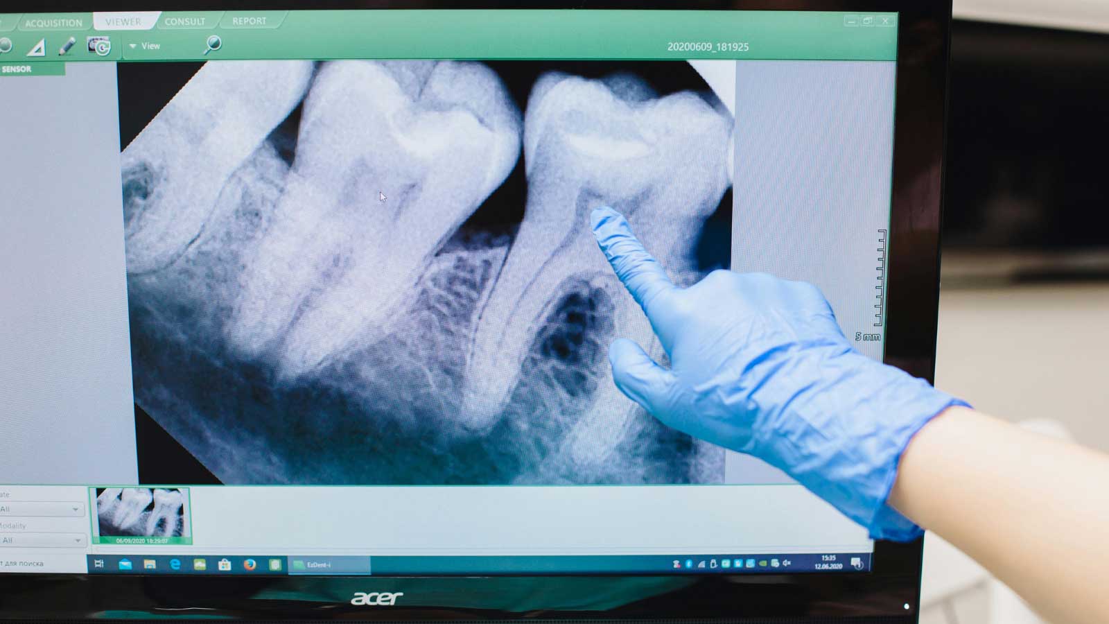 Tooth Pain When Chewing? It Could Be a Cracked Tooth