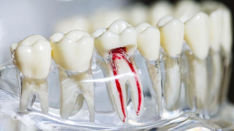 Root Canal Pain After Treatment: What’s Normal and What’s Not?