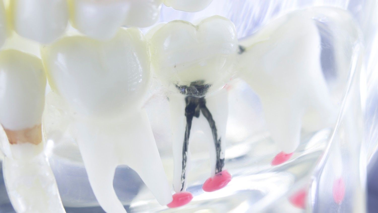What to Do When a Root Canal Fails | Renovo Endodontic Studio