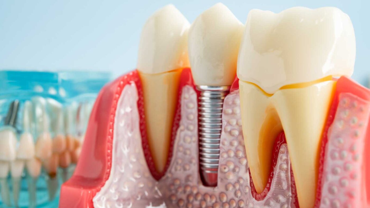 Do You Really Need a Root Canal? When to See a Specialist